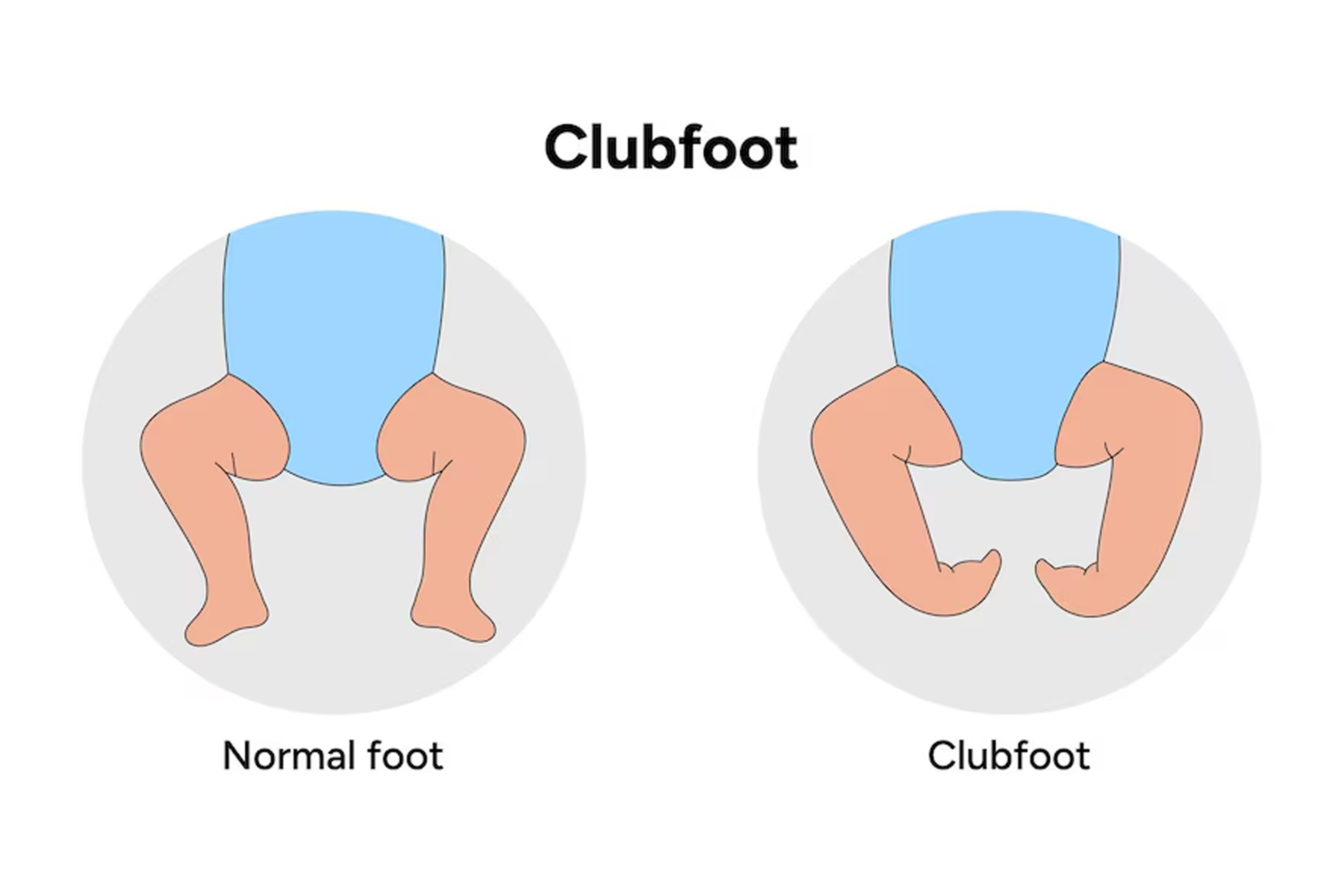 Twisted Foot in Babies | Clubfoot Treatment & Management | KM NU Hospitals